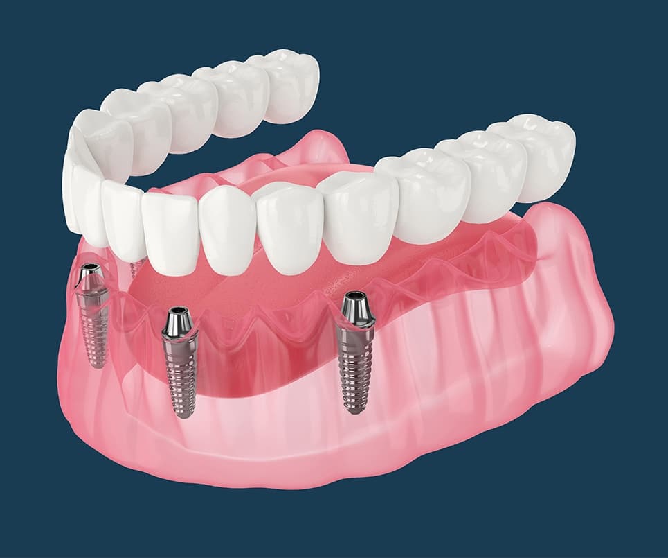 Implants - Smiles Only